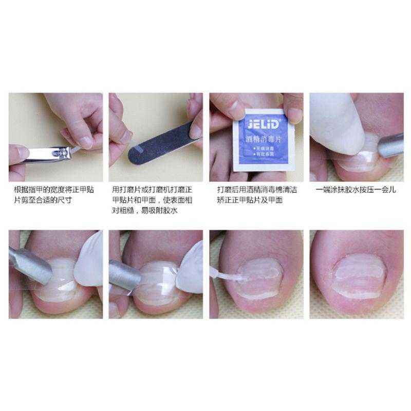 Buy 10Pcs Ingrown Toenails Treatment Straightening Tape Curved Clip ...