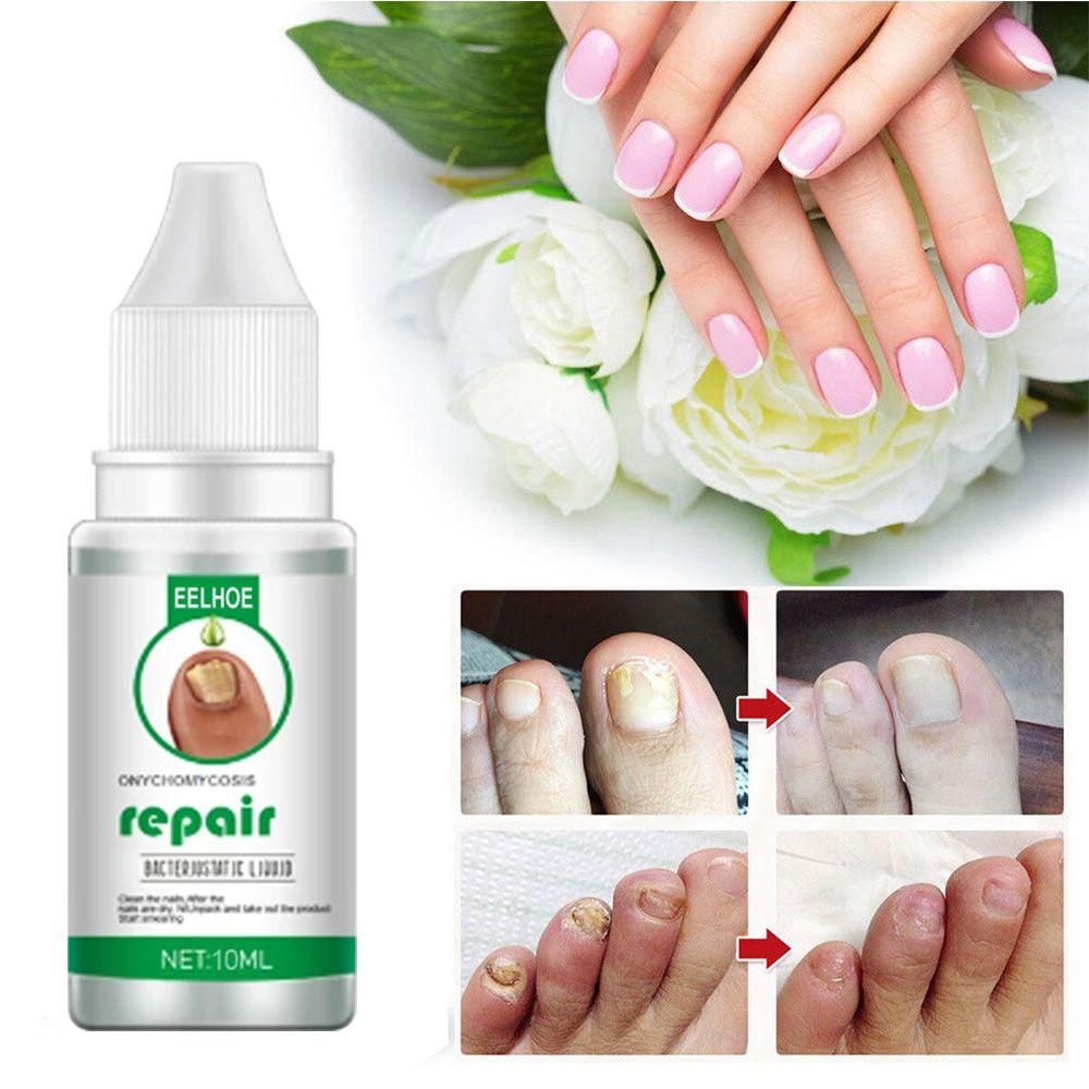 Buy 2021 Nail Repair Effective Treatment Toenail Care Solution ...