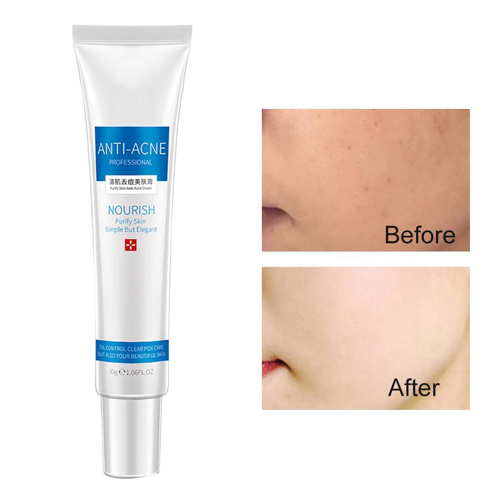 Buy Acne Comedo Removal Shrink Pores Oil Control Moisturizing Skin Care ...