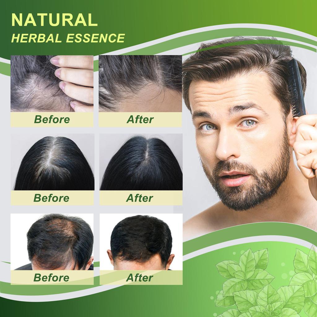 Kaufe ELAIMEI Haarwuchs Shampoo Anti Haarausfall Shampoo Nachwachsen ...