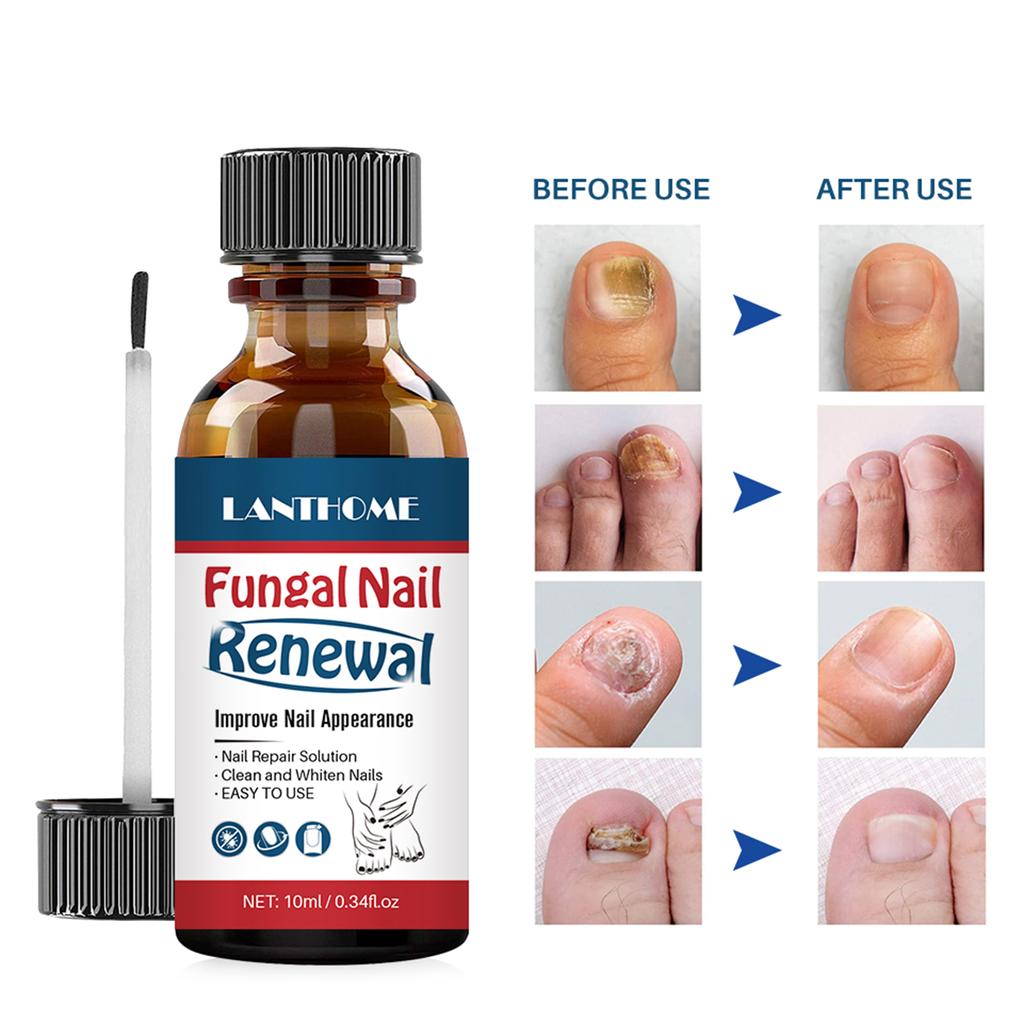 Buy LANTHOME 10ml Fangal Nail Renewal Enhanced Nail Repair Solution ...