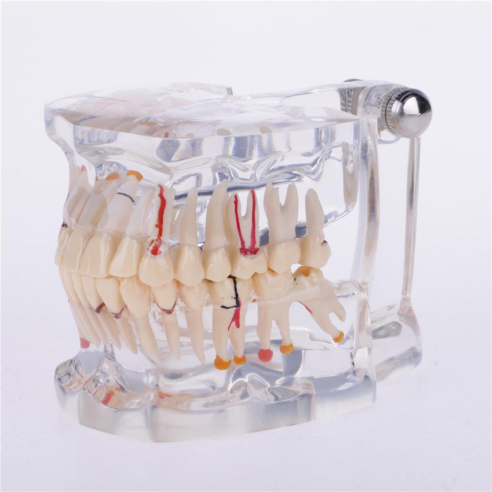 Buy Dental Study Teeth Model Transparent Adult Pathological Disease ...