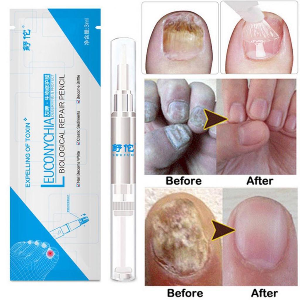 Buy Onychomycosis Paronychia Treatment Nail Toe Care Herbal Anti Fungus ...