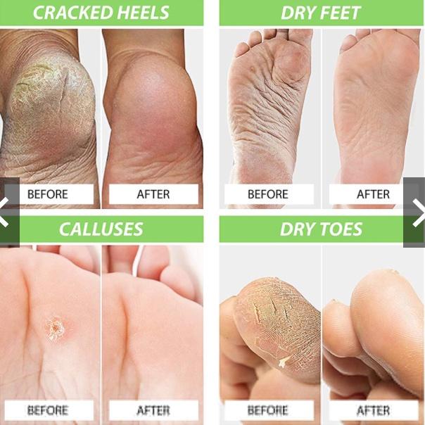 Buy Foot Cure All-Natural Plant Foot Balm – Moisturizing Foot Care ...