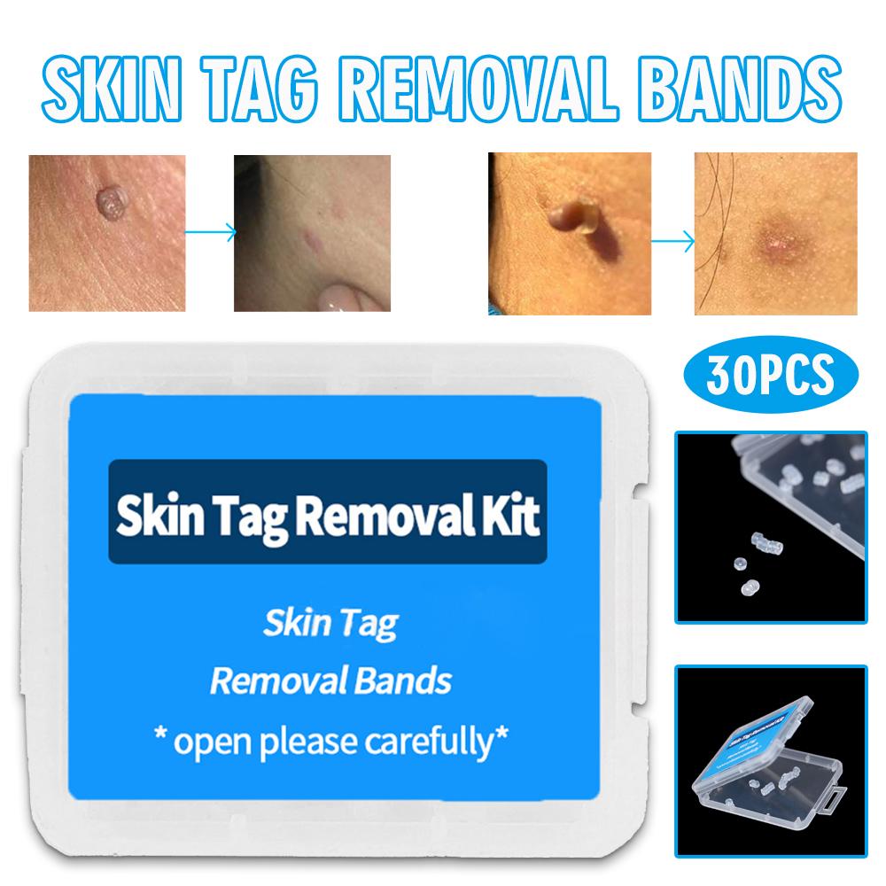 Buy 30Pcs/box Skin Tag Removal Rubber Bands Micro Band Non Toxic Face ...