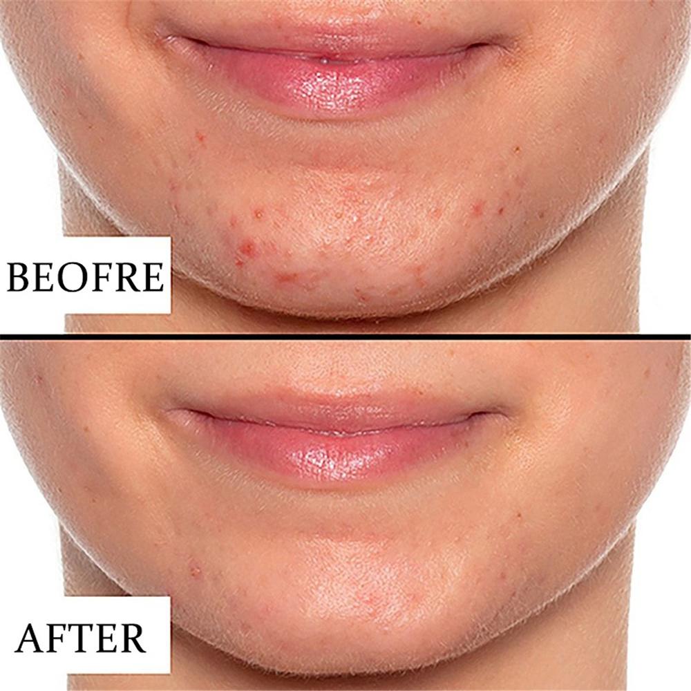Cheap Acne Repair Cream Face Care Anti Acne Removal Gel Whitening ...