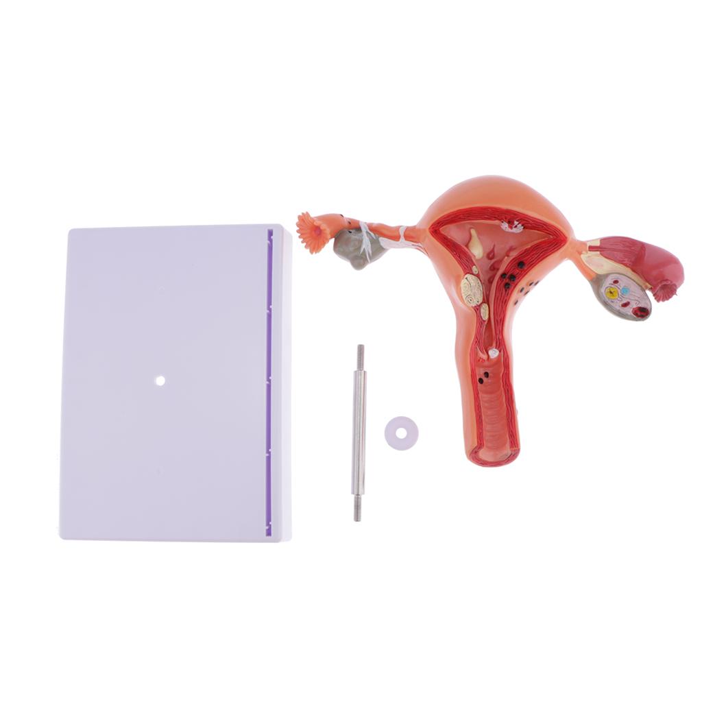 Gynecology Patient Education Transparent Female Reproductive Organ ...