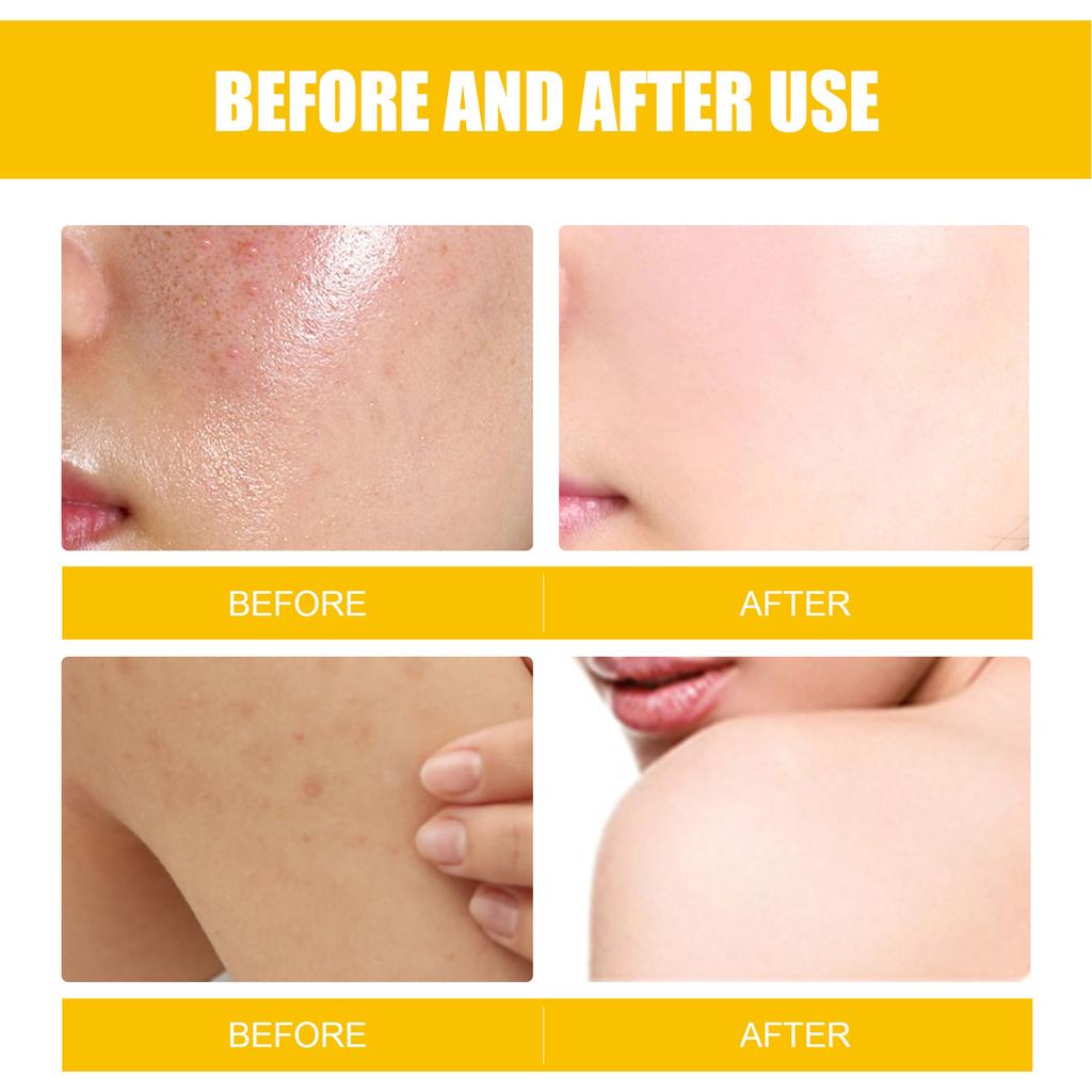 Cheap EELHOE Herbal Acne Removal Face Cream Oil Control Anti-Acne Gel Treatment Acne Mark Skin ...