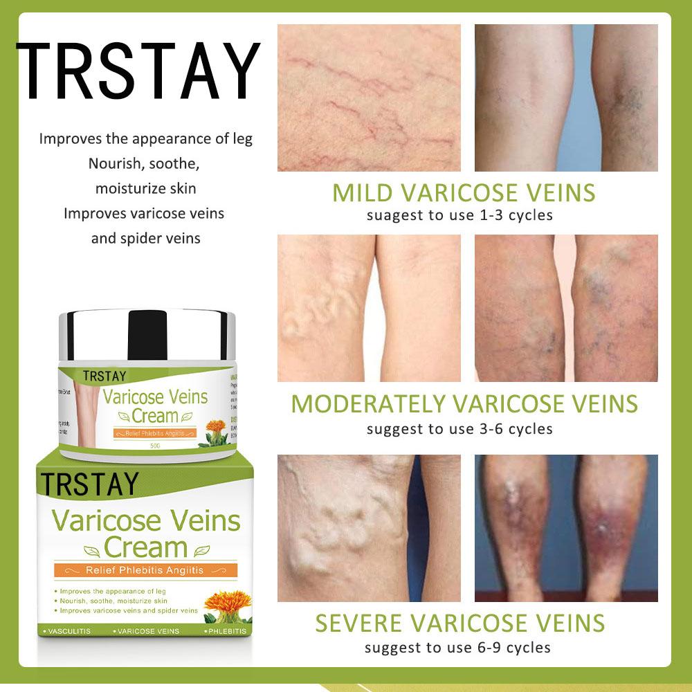 Vein cream ointment earthworm leg blue veins bulge relieve pain red ...