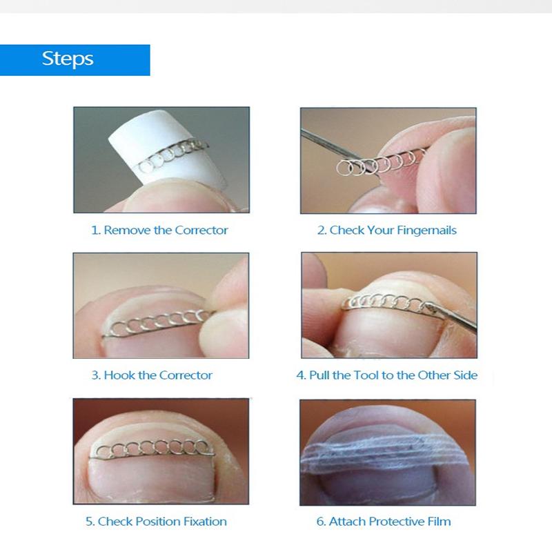 Buy 12pcs Toe Nail Correction Ingrown Wire Fixer Paronychia Onyxis ...