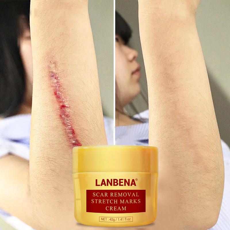Buy Herb Scar Removal Cream Face Cream Skin Repair Face Cream Acne ...