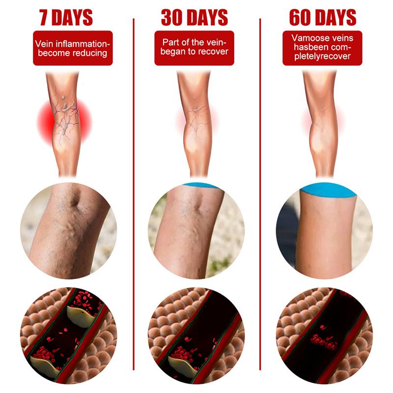 Buy Treat Varicose Vascular Inflammation Massage Cream Cure Varicose ...