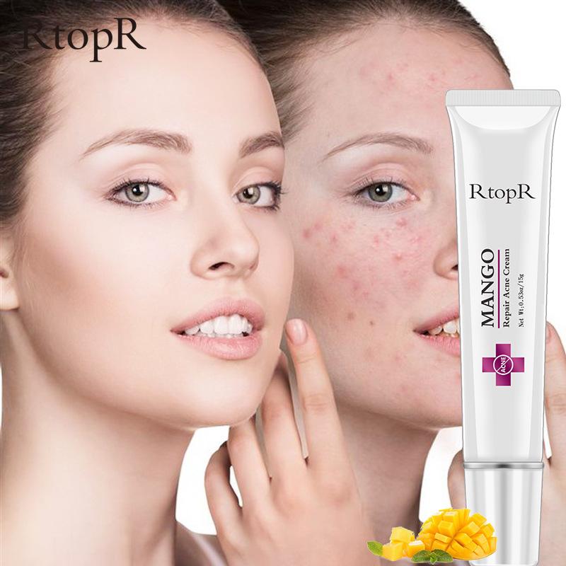 Buy RtopR Mango Repair Acne Cream Anti Acne Spots Acne Treatment Scar ...