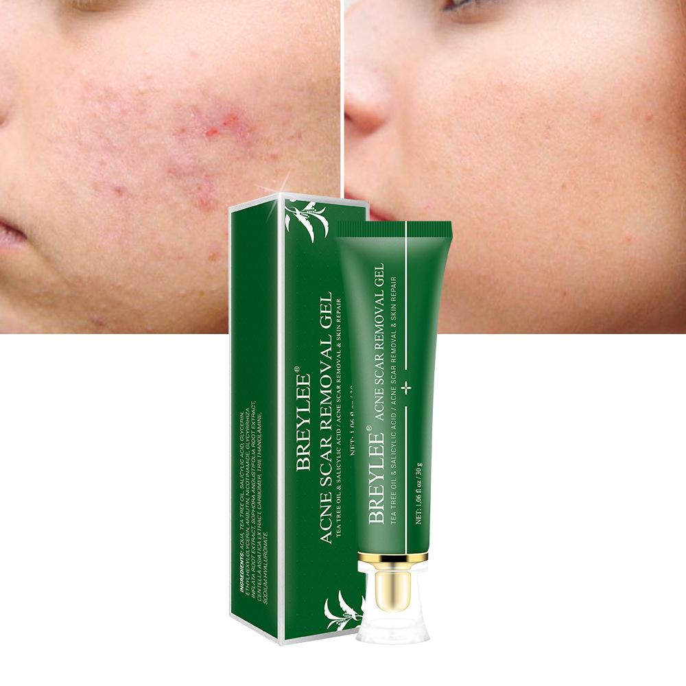Cheap BREYLEE Against Face Acne Pimple Remover Acne Treatment Cream ...
