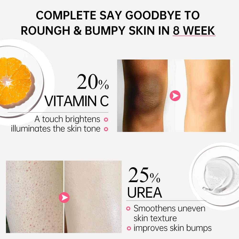 Cheap Body Cream Chicken Skin Removal Treatment Keratosis Pilaris ...