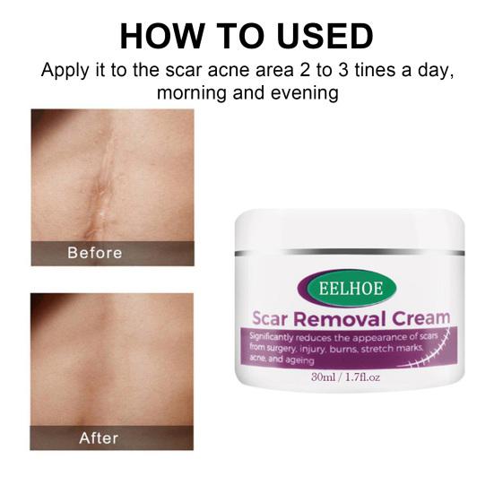 Kaufe 30ML Acne Mark Ointment Easily Penetrate Prevent Redness Mild ...