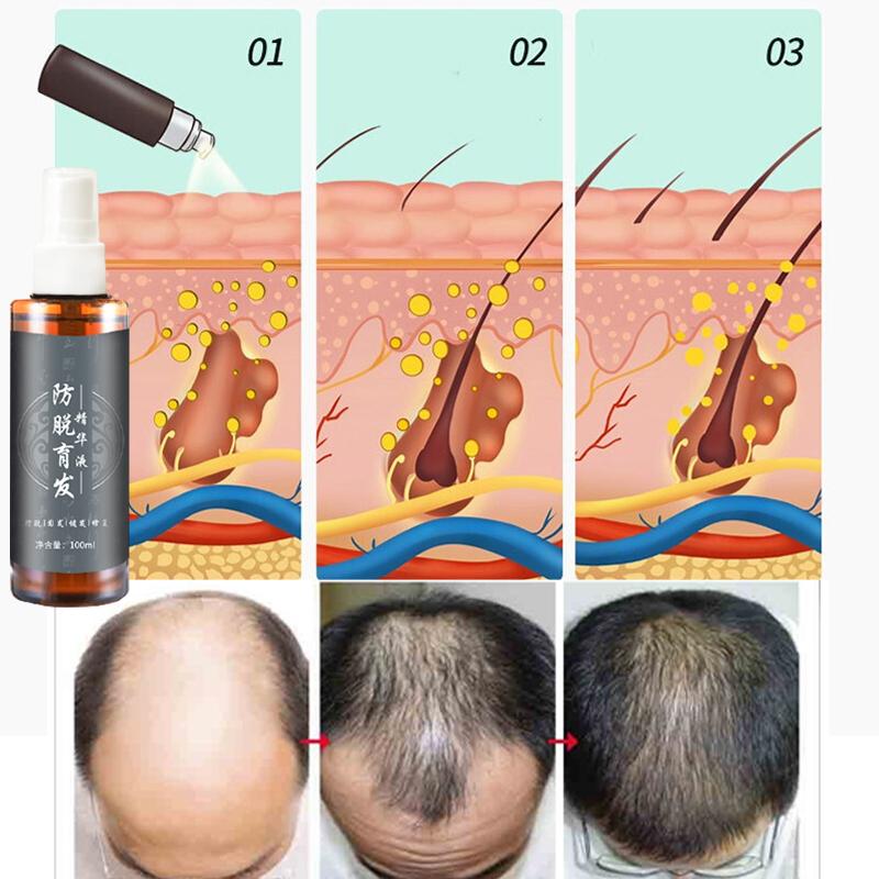 Buy Magic Hair Regrowth Spray Essence Serum Health Hair Grow Liquid ...