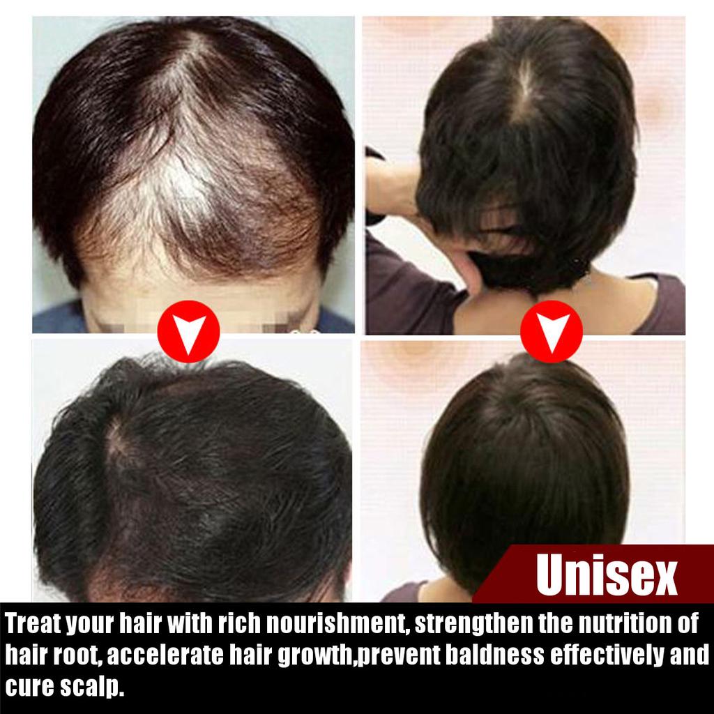 Buy 30ml Hair Growth Oil Hair Care Fast Grow Treatment Prevent Hair ...