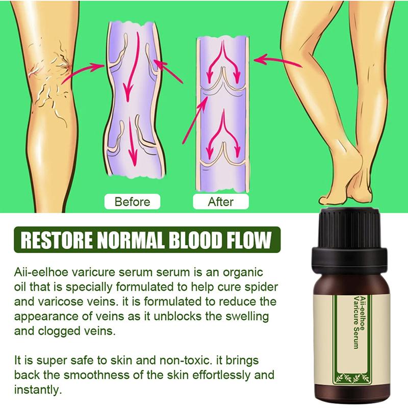Buy Treat Varicose Vascular Inflammation Massage Cream Cure Varicose ...