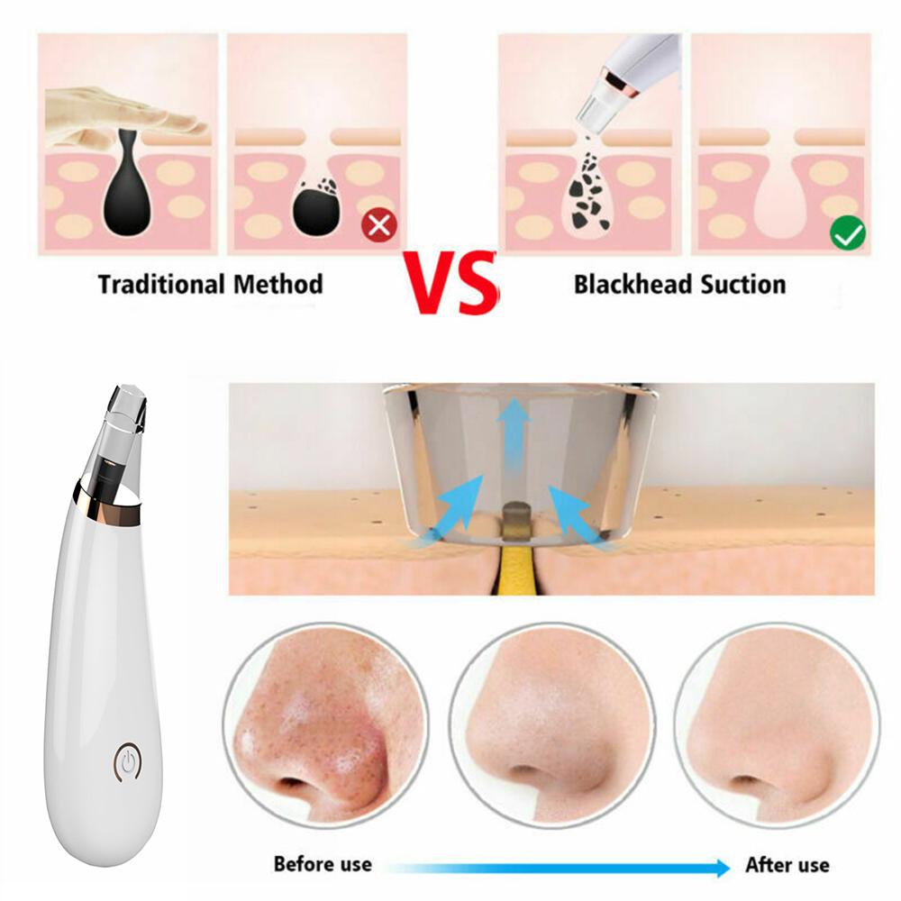 Buy 2020 Electric Facial Pore Cleanser Skin Sucker Blackhead Removal ...
