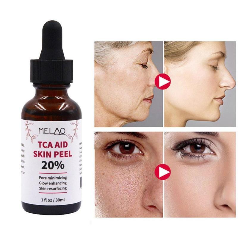 Buy Tca Aid Skin Peel Trichloroaectic Acid 20% Skin Peel Pore Minizing ...