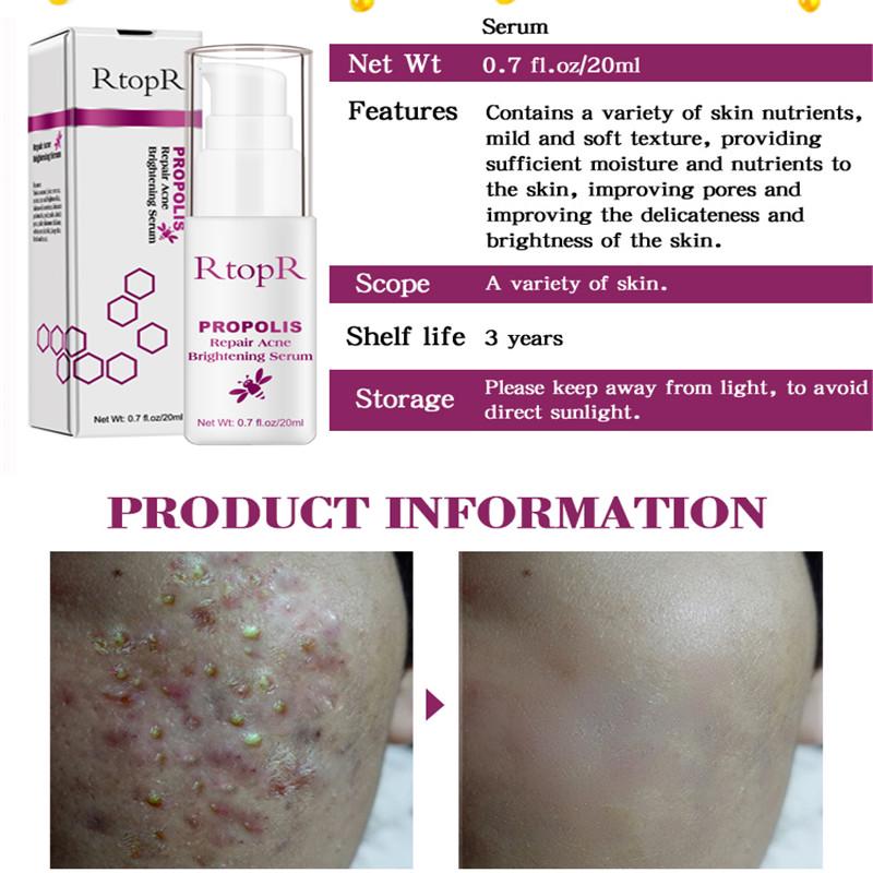 Propolis Repair Acne Brightening Serum Scar Spots Cleaning Shrink Pores ...