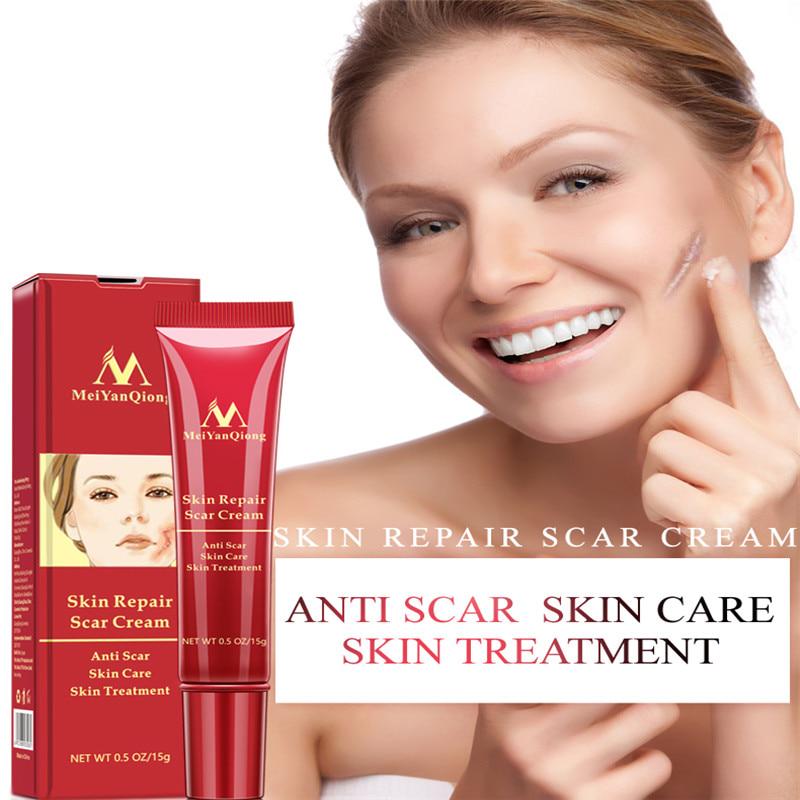Buy Buy 2 Get 1 Brand New Hot Acne Scar Stretch Mark Repair Cream ...