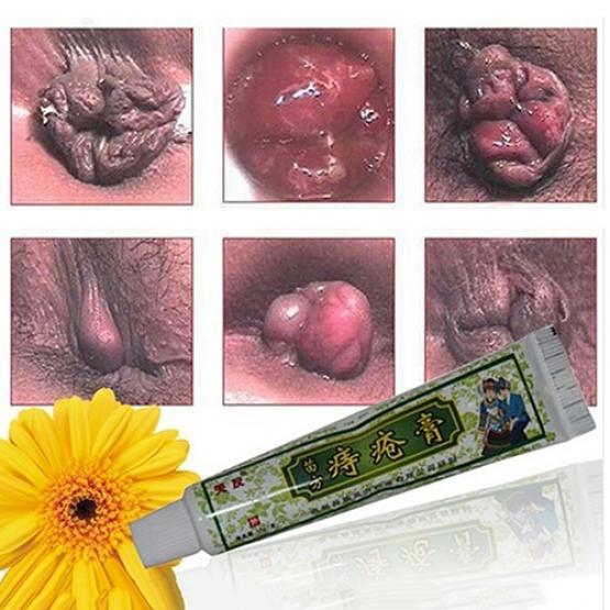 Buy Hemorrhoids Ointment External Treatment Cream No Pain at affordable ...