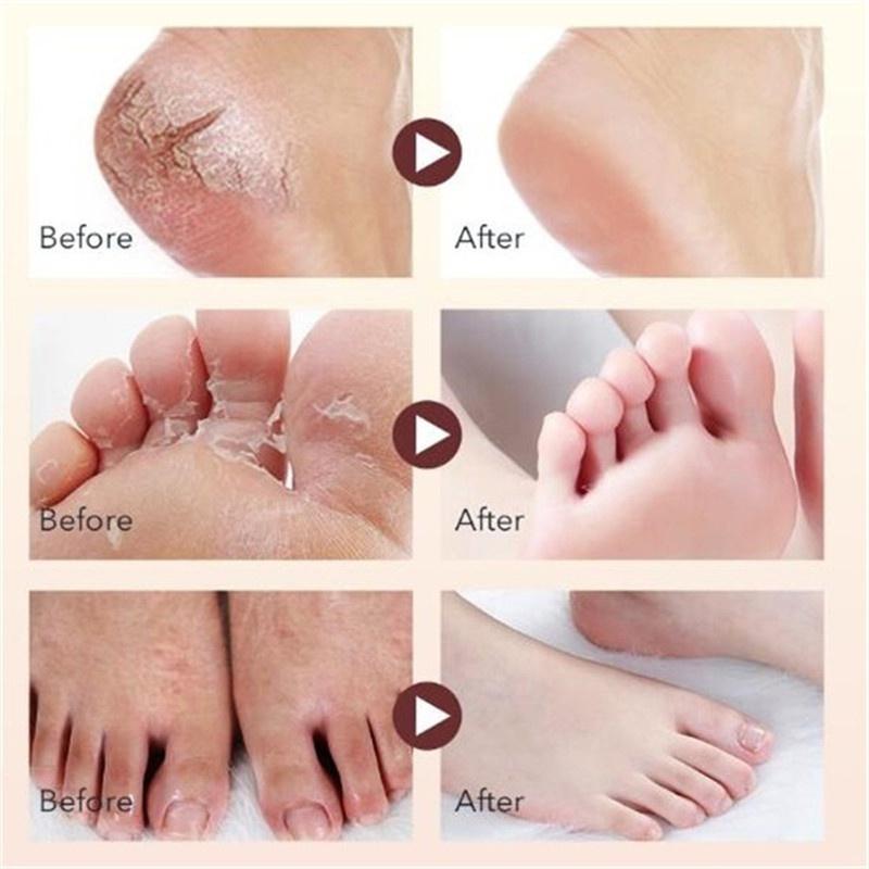 Buy Hand and Foot Chapped Cream Foot Blister Peeling Scar Bad Foot ...